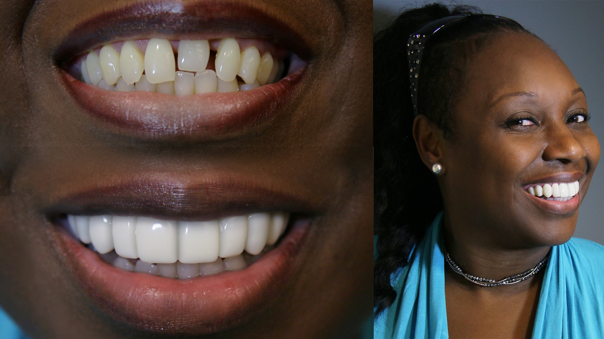12 Minute Challenge Smile Makeover from Brighter Image Lab