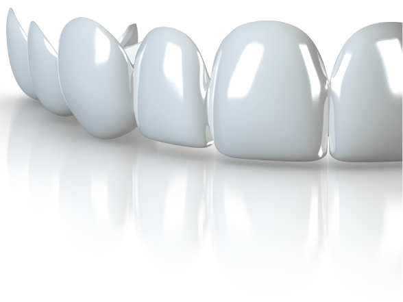 Temporary Veneers | Your No Dentist Solution!