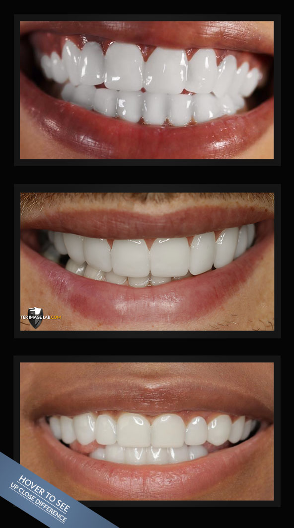 Knock Off Page - Dental Veneers | Brighter Image Lab
