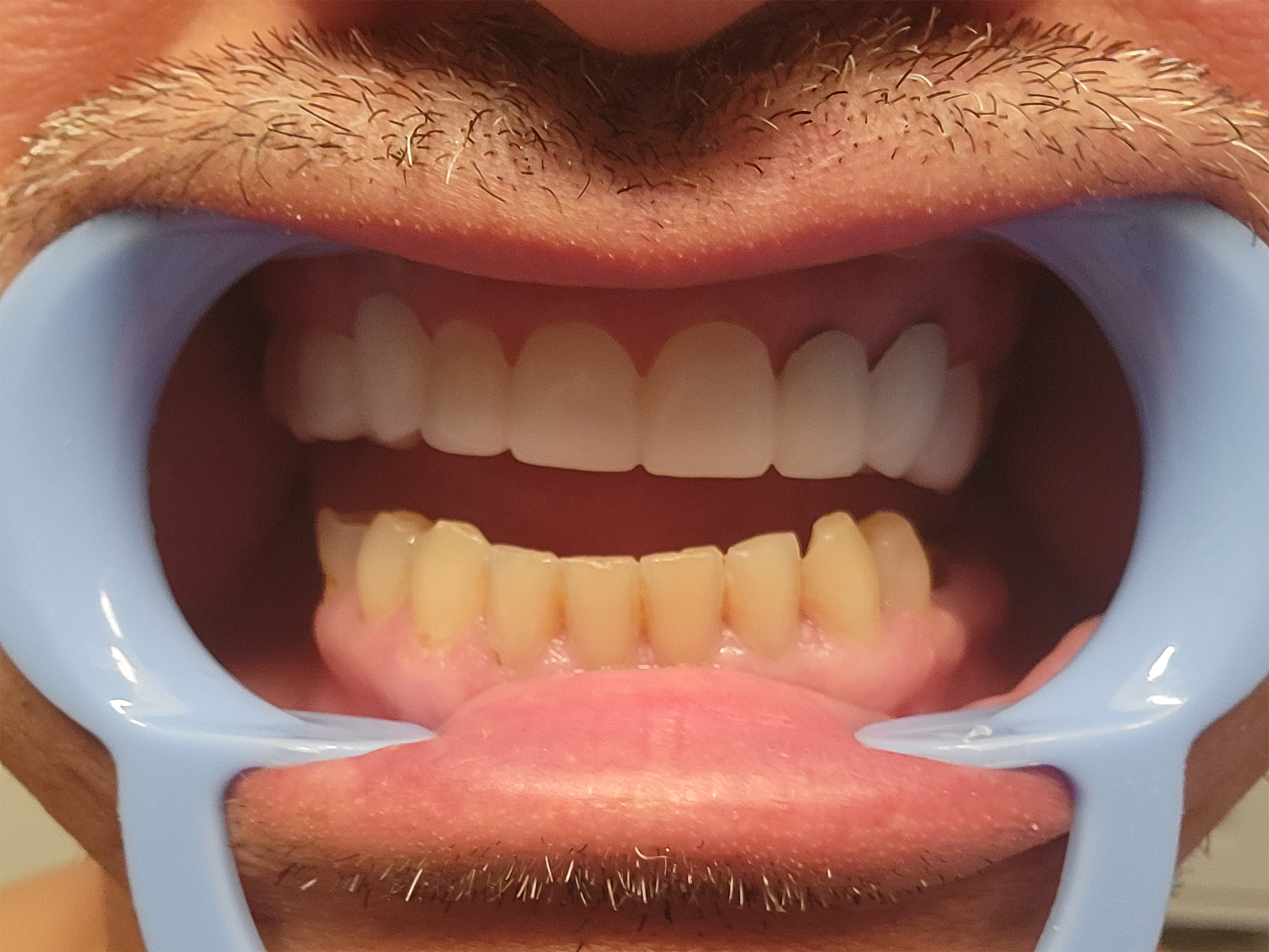 Exposing Misleading Reviews: Scott Cheney - Dental Veneers | Brighter ...