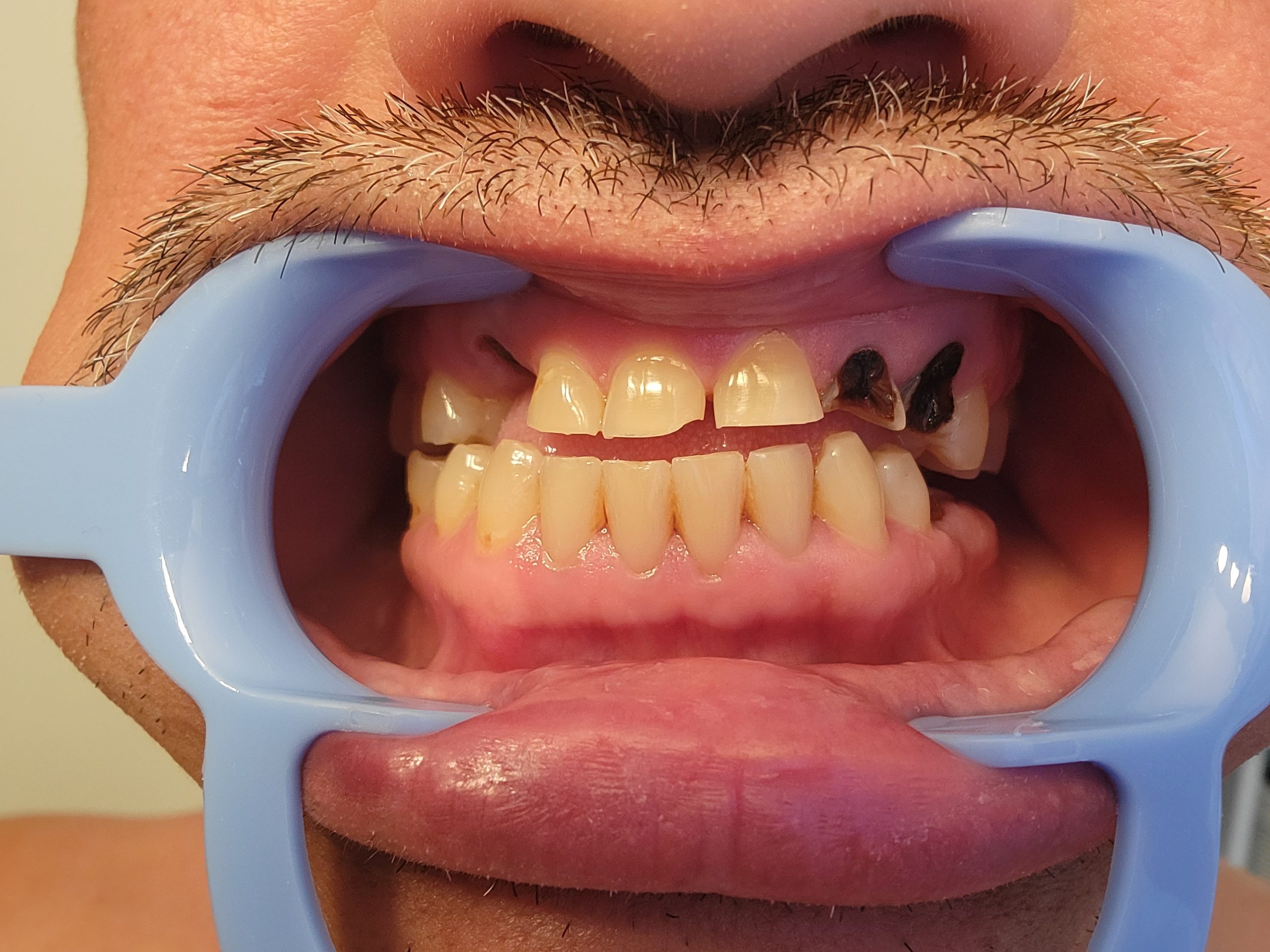 Exposing Misleading Reviews: Scott Cheney - Dental Veneers | Brighter ...